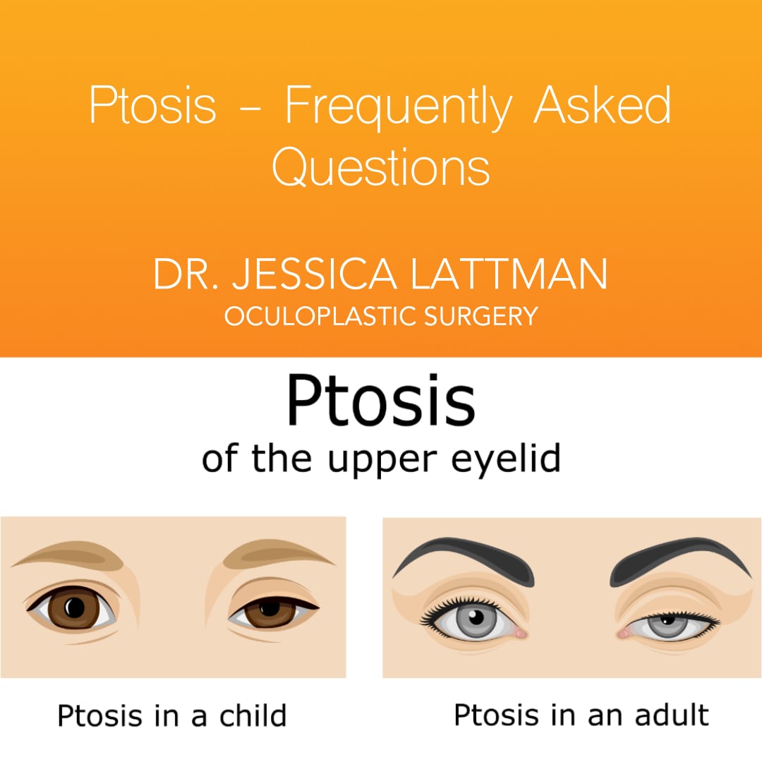 Ptosis Frequently Asked Questions FAQ's | New York's Ptosis Specialist ...